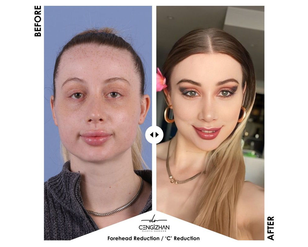 Forehead Reduction Surgery in Turkey: Why More Patients Are Choosing ...